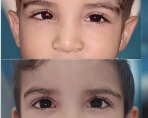 Paediatric Eye Care | Dr. Sreekanth Eye Care & Research Centre