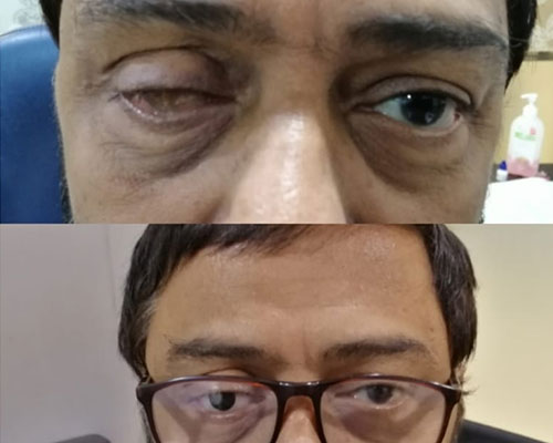 Oculoplasty And Aesthetic Surgery | Dr. Sreekanth Eye Care & Research ...